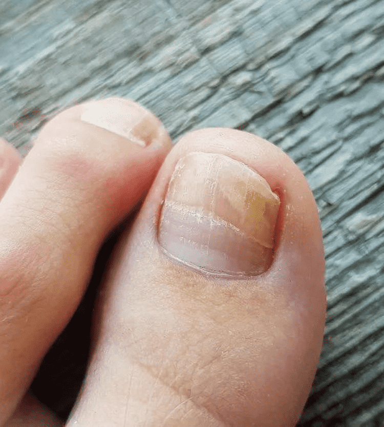 Understanding Nail Fungus: Causes, Signs, and Treatment Options